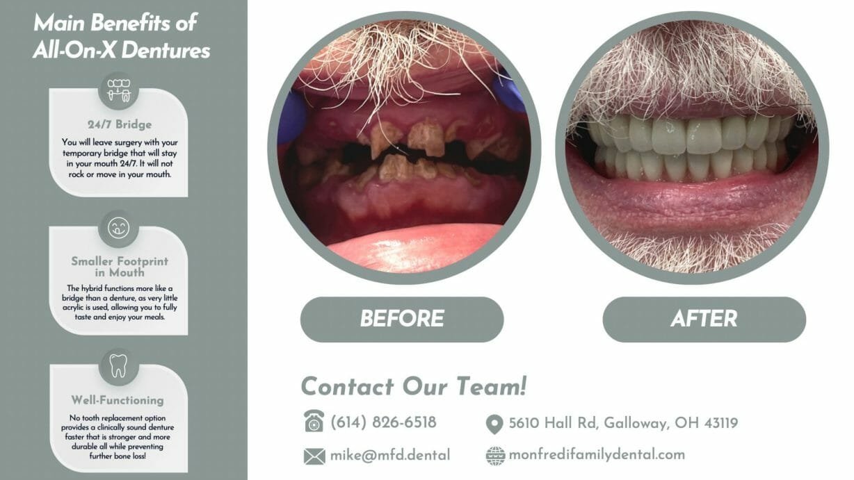 MFD Can Restore Your Smile With A Hybrid Denture Entirely In Office ...
